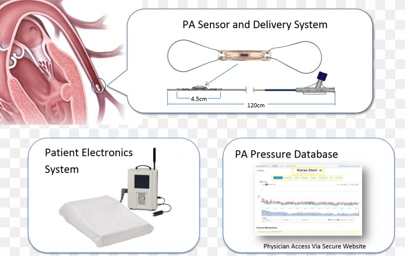 Pulmonary Artery CardioMEMS Cardiac Catheterization Monitoring 