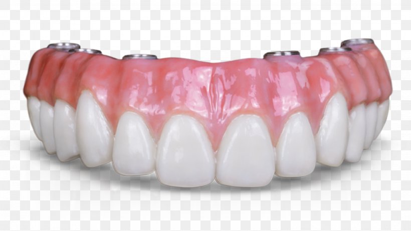 Dental Implant Dentures Dentistry Prosthesis Fixed Prosthodontics, PNG ...
