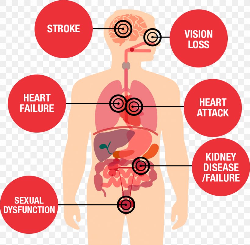 Hypertension Blood Pressure Cardiovascular Disease Blood Vessel PNG