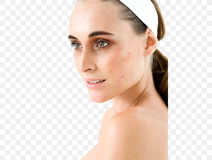 Hyperpigmentation Face Melasma Therapy Human Skin Color, PNG, 641x618px ...